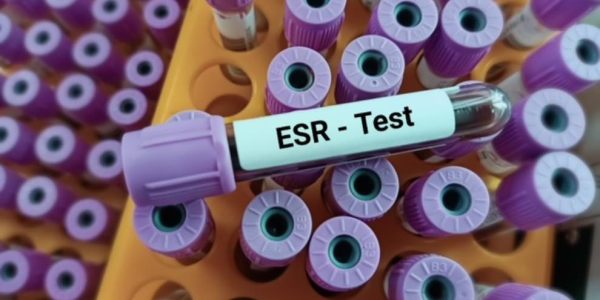 Is it Time for an ESR Test? Key Signs and Benefits | The Lifestyle Daily
